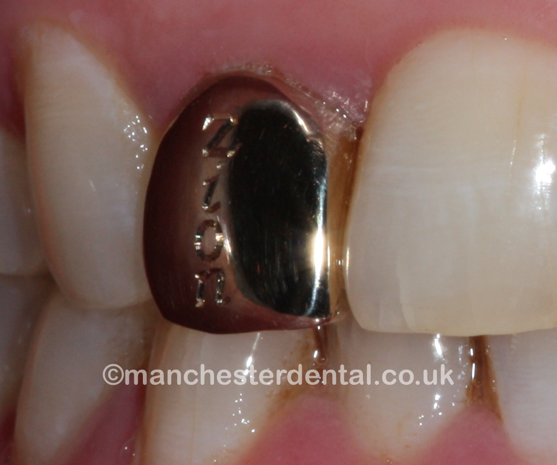 Gold Teeth / Gold Crowns - Manchester Dental
