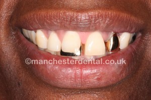 Gold Teeth / Gold Crowns - Manchester Dental