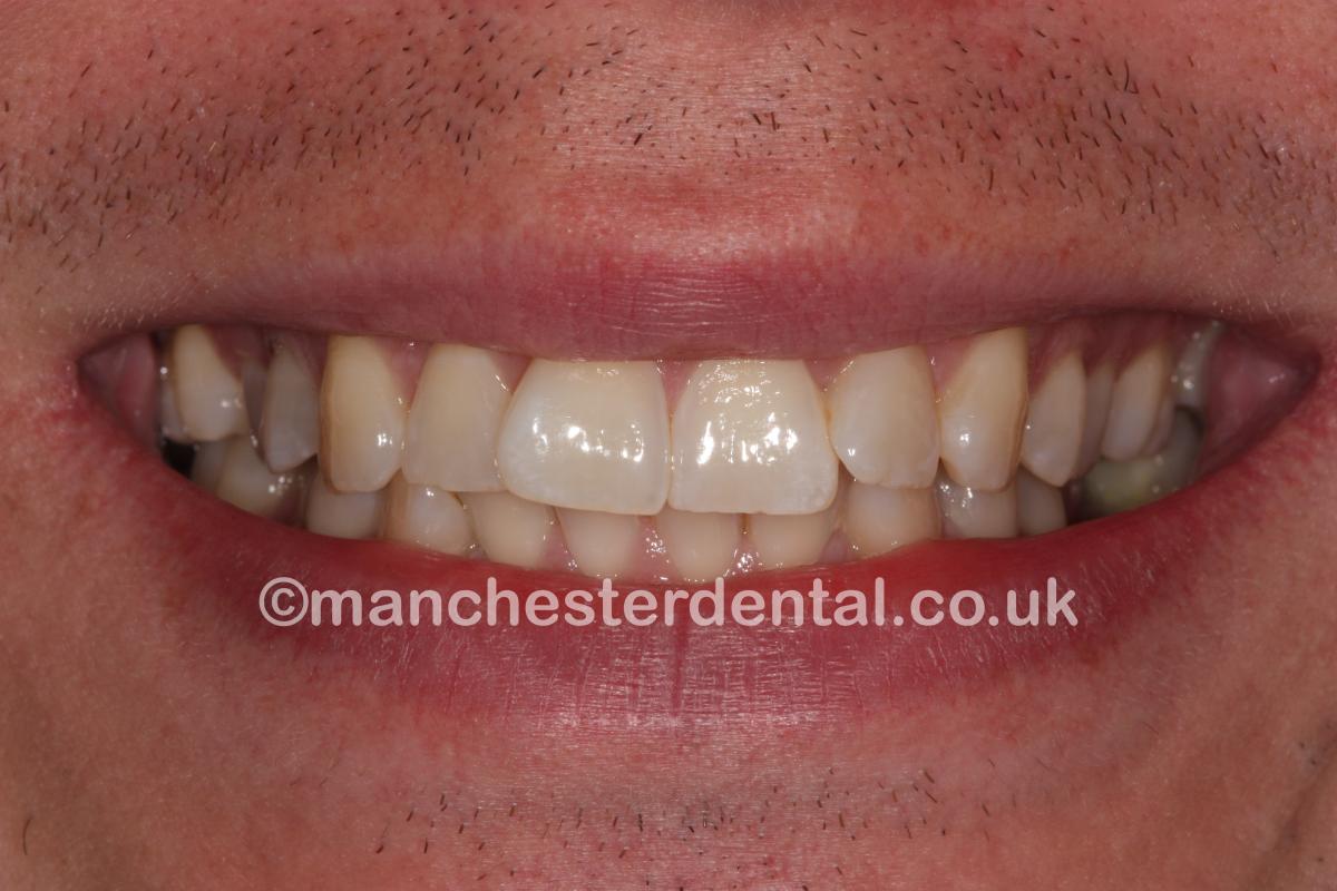Gold Teeth / Gold Crowns - Manchester Dental