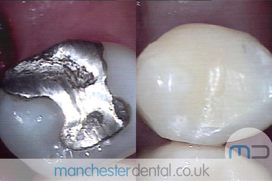 White Fillings - Manchester Dental