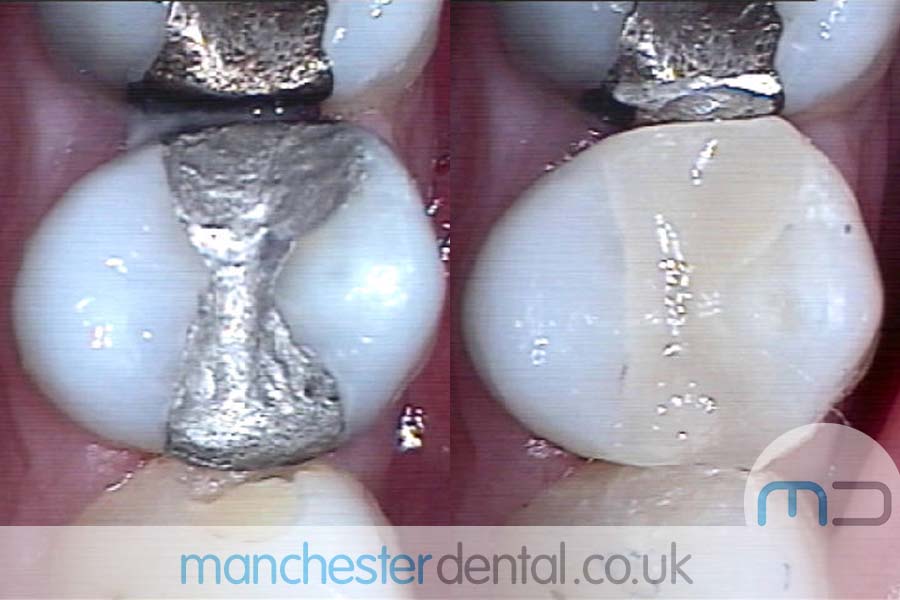 White Fillings - Manchester Dental