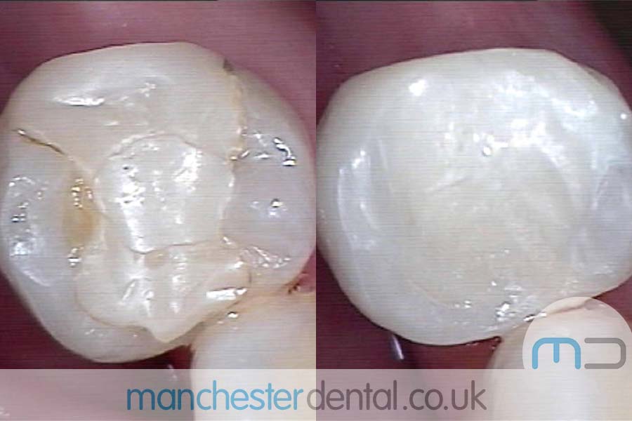 White Fillings - Manchester Dental