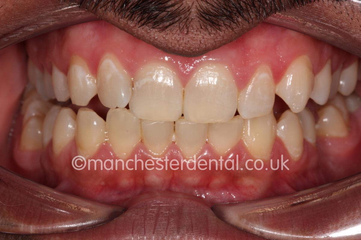 Gold Teeth / Gold Crowns - Manchester Dental