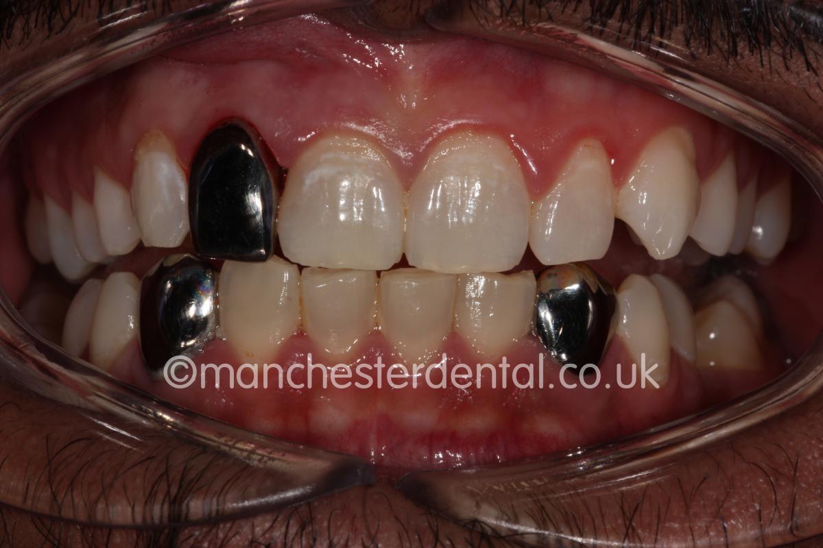 Gold Teeth / Gold Crowns - Manchester Dental