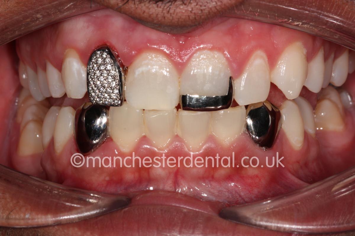 Gold Teeth / Gold Crowns - Manchester Dental