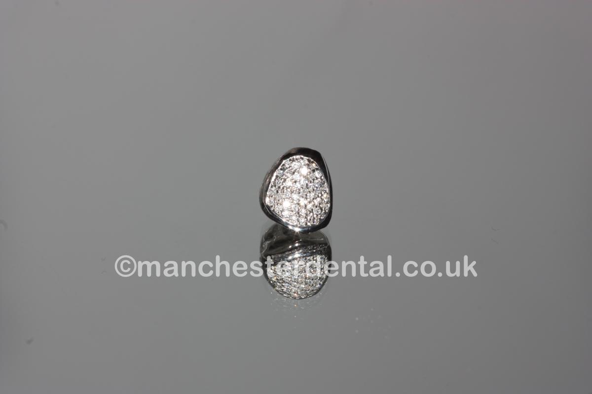 Gold Teeth / Gold Crowns - Manchester Dental