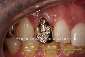 Gold Teeth / Gold Crowns - Manchester Dental