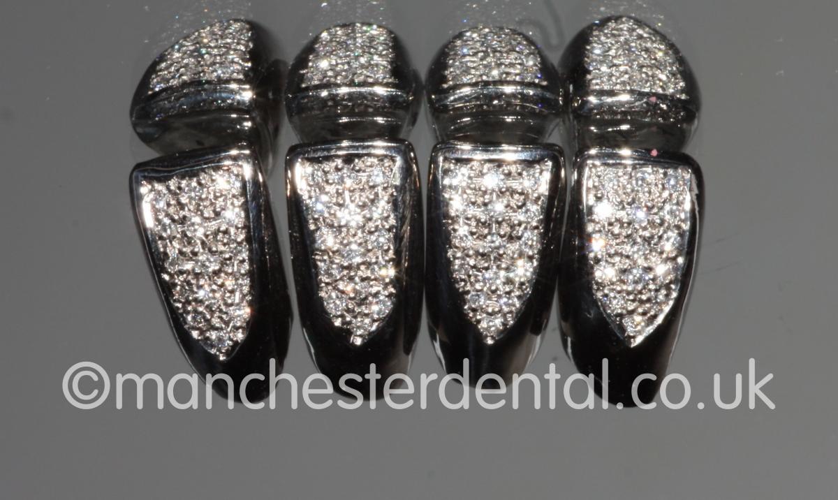 Gold Teeth / Gold Crowns - Manchester Dental